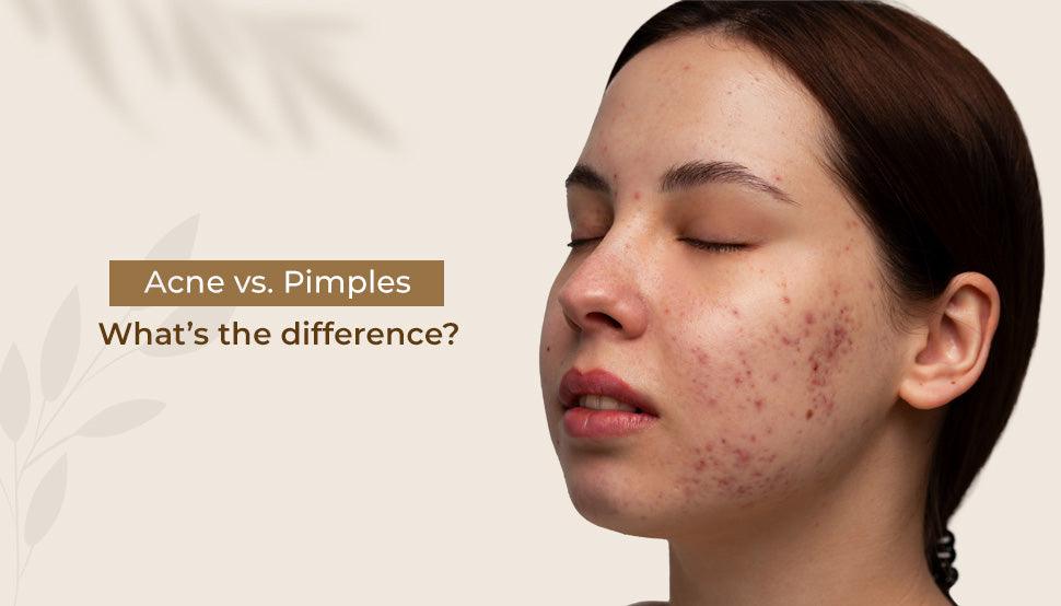 Acne vs. Pimples: What’s the Difference? – Indus Valley