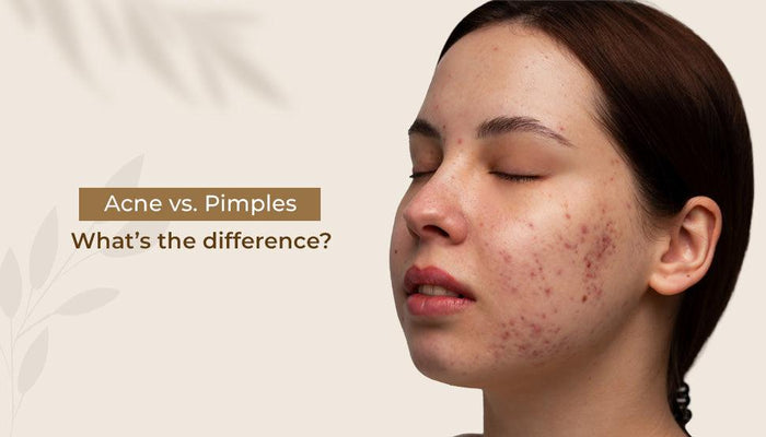 Acne vs. Pimples: What’s the Difference? – Indus Valley