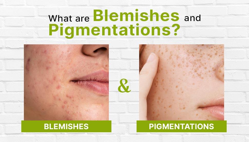 What are Blemishes and Pigmentation? Ways to Get Rid of Them – Indus Valley